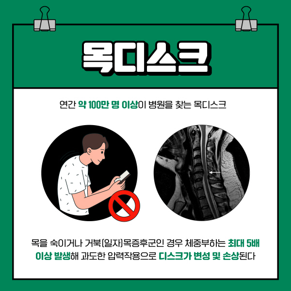 겨울이면 더 심해지는 목디스크 증상 표적치료로 해결
